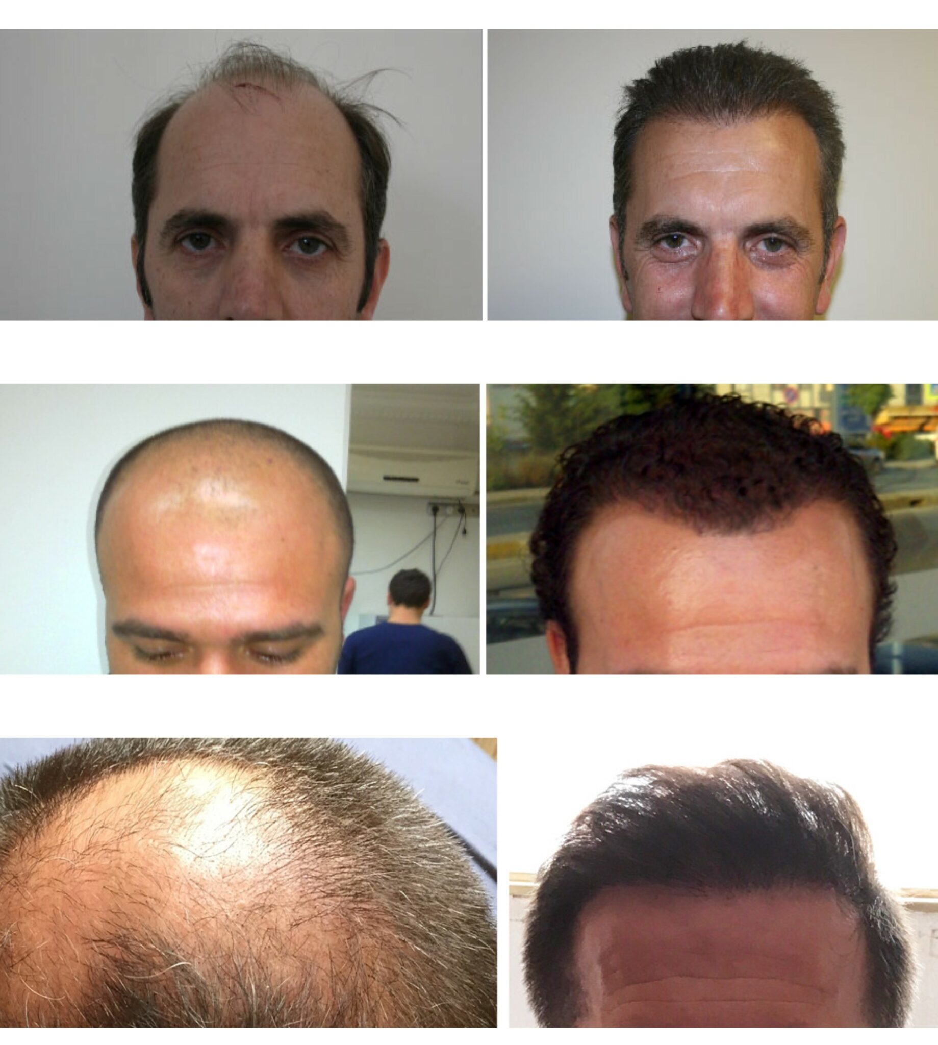 Transplant de par - Travel Medical